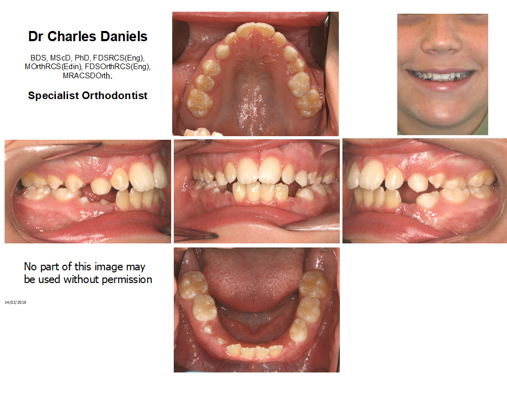 Nose Breathing Problems And Orthodontics North Sydney Orthodontics Nose Breathing Problems And Orthodontics North Sydney Orthodontics